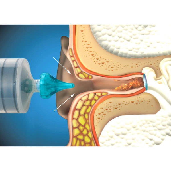 Wellys - Seringue d'extraction de cérumen